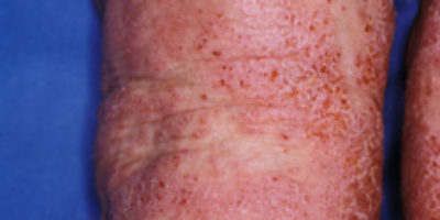 Neurodermitis (atopisches Ekzem) von A bis Z | Medumio