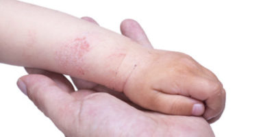 Neurodermitis (atopisches Ekzem) von A bis Z | Medumio