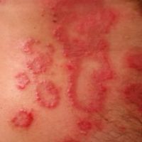 21 Bilder von Schuppenflechte - so erkennen Sie Psoriasis! | www.medumio.de